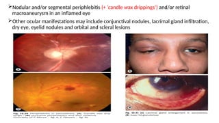 ocular manifestations of autoimmune disease.pptx
