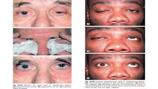ocular manifestations of autoimmune disease.pptx
