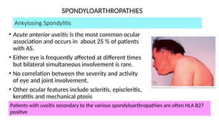 ocular manifestations of autoimmune disease.pptx