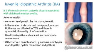ocular manifestations of autoimmune disease.pptx