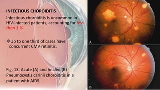Ocular manifestations of hiv | PPTX