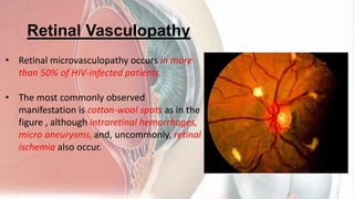 Ocular manifestations of hiv | PPTX