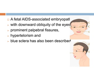 Ocular manifestations of HIV | PPTX
