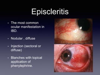 Ocular Manifestations of Inflammatory Bowel Disease | PPTX | Eye and ...