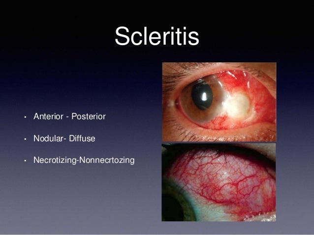 Ocular Manifestations of Inflammatory Bowel Disease