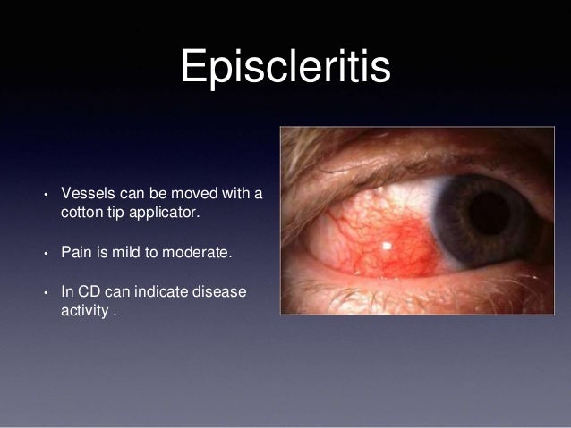 Ocular Manifestations of Inflammatory Bowel Disease