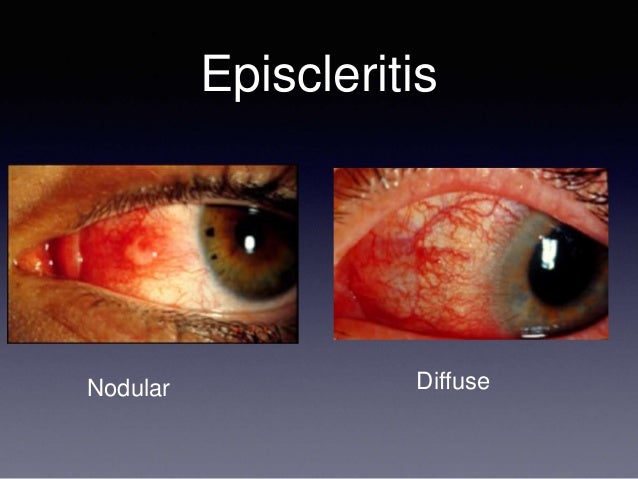 Ocular Manifestations of Inflammatory Bowel Disease