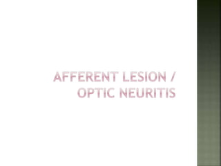 Ocular manifestations of multiple sclerosis | PPTX