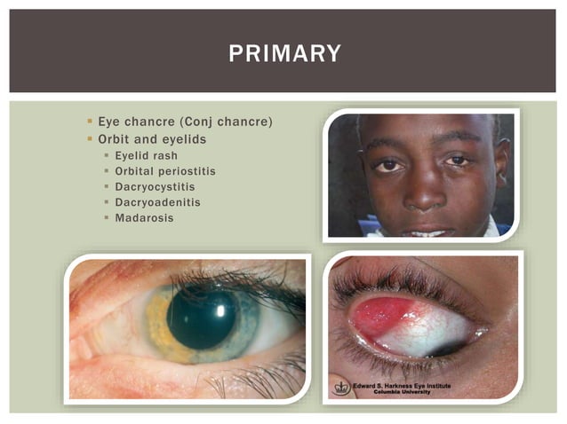 Ocular manifestations of syphilis