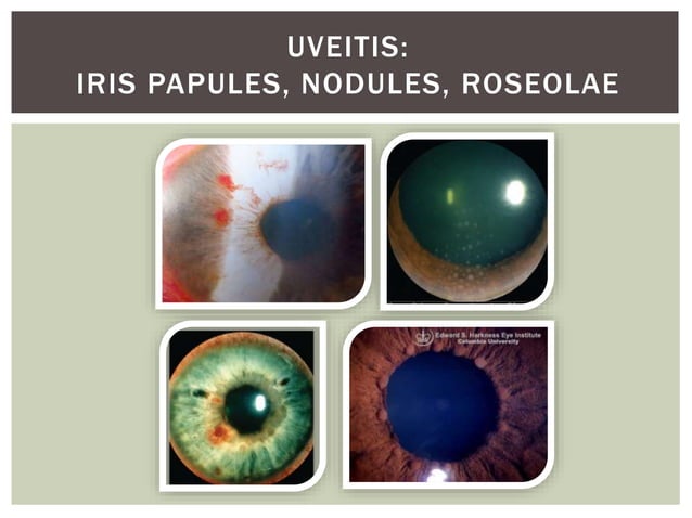 Ocular manifestations of syphilis