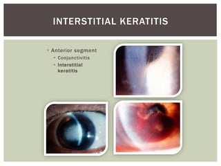 Interstitial Keratitis Syphilis