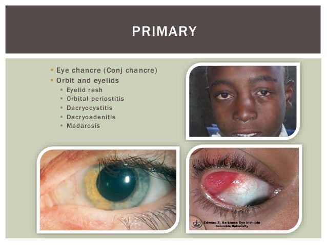 Ocular manifestations of syphilis