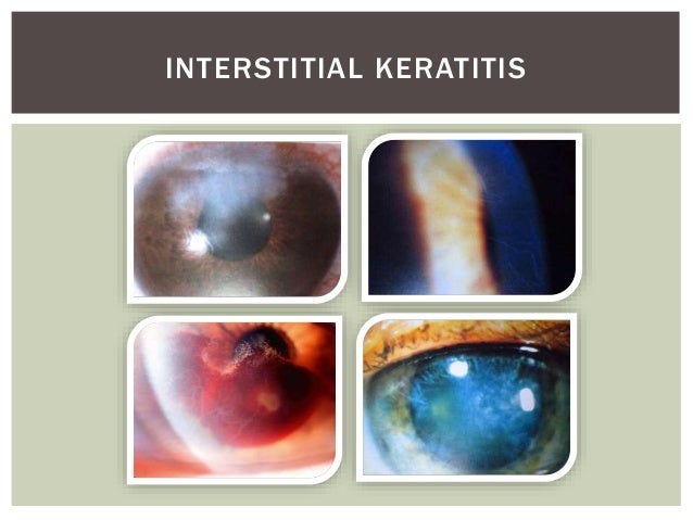 Ocular manifestations of syphilis