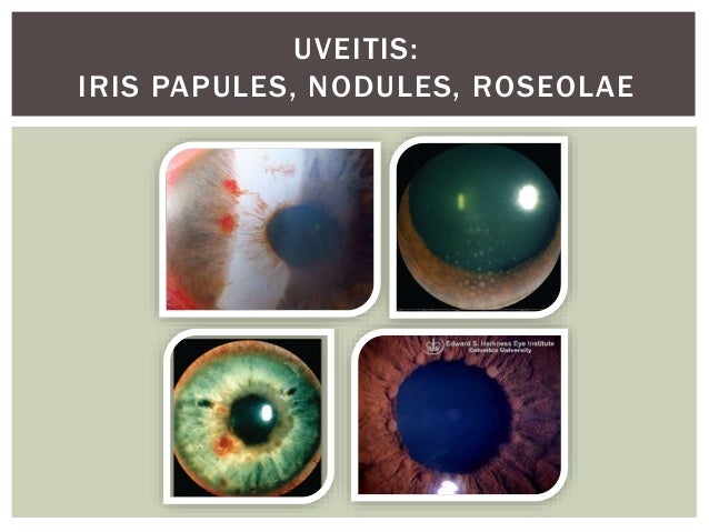 Ocular manifestations of syphilis