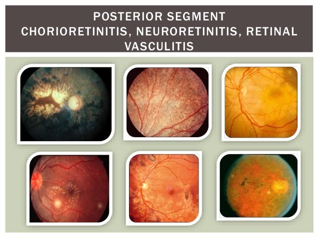 Ocular manifestations of syphilis