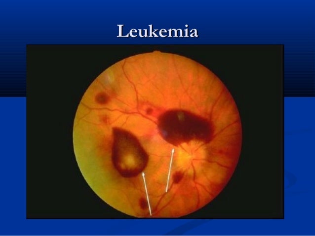 Hyperviscosity Retinopathy