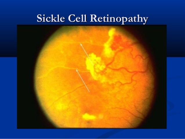 Sickle Cell Retinopathy