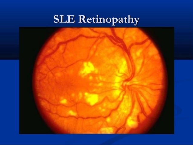 Ocular manifestations of systemic disease