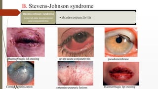 Ocular manifestations of systemic diseases | PPTX