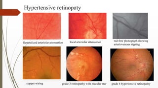 Ocular manifestations of systemic diseases | PPTX