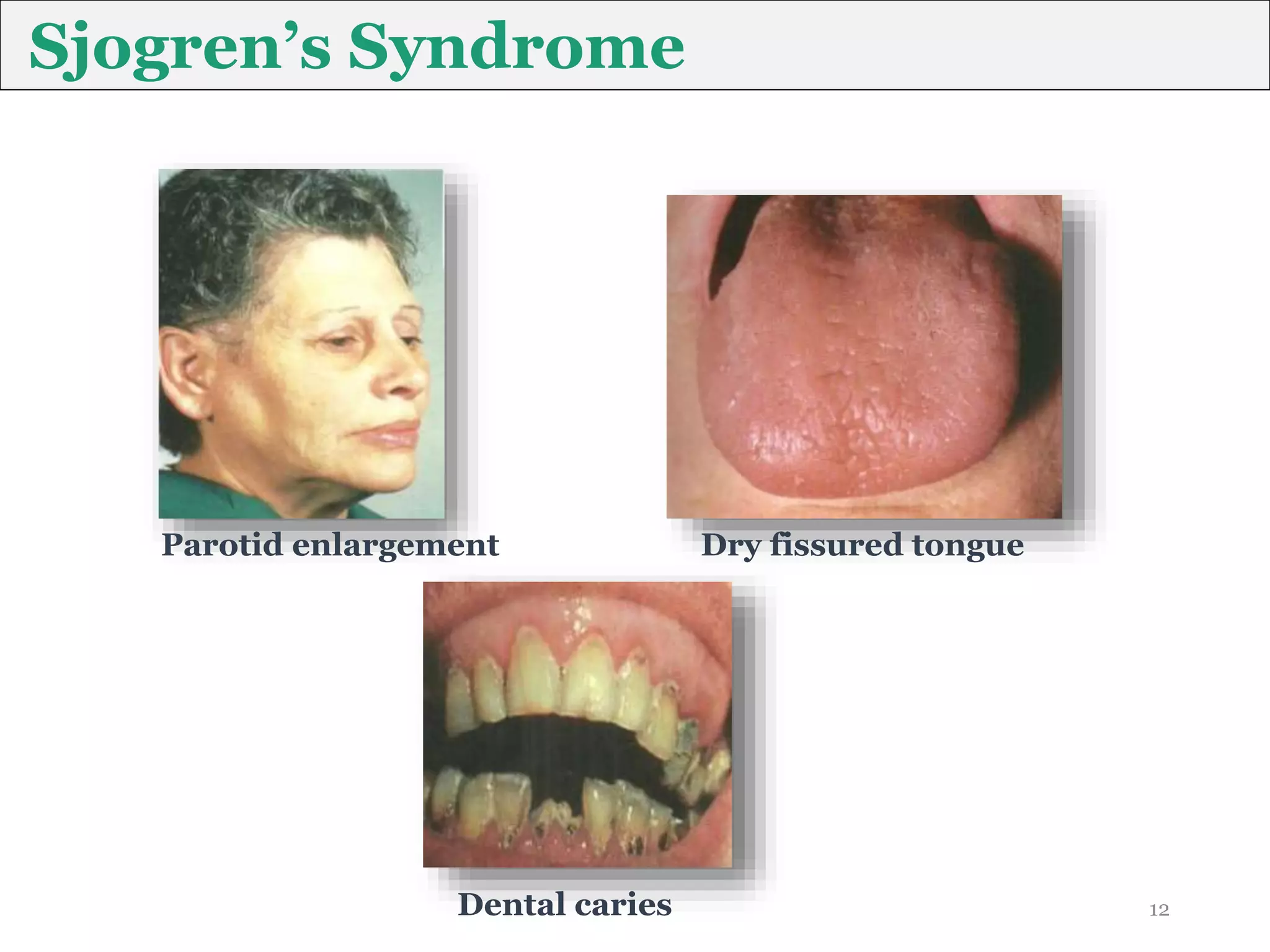 Ocular_manifestations_of_systemic_ds..pptx