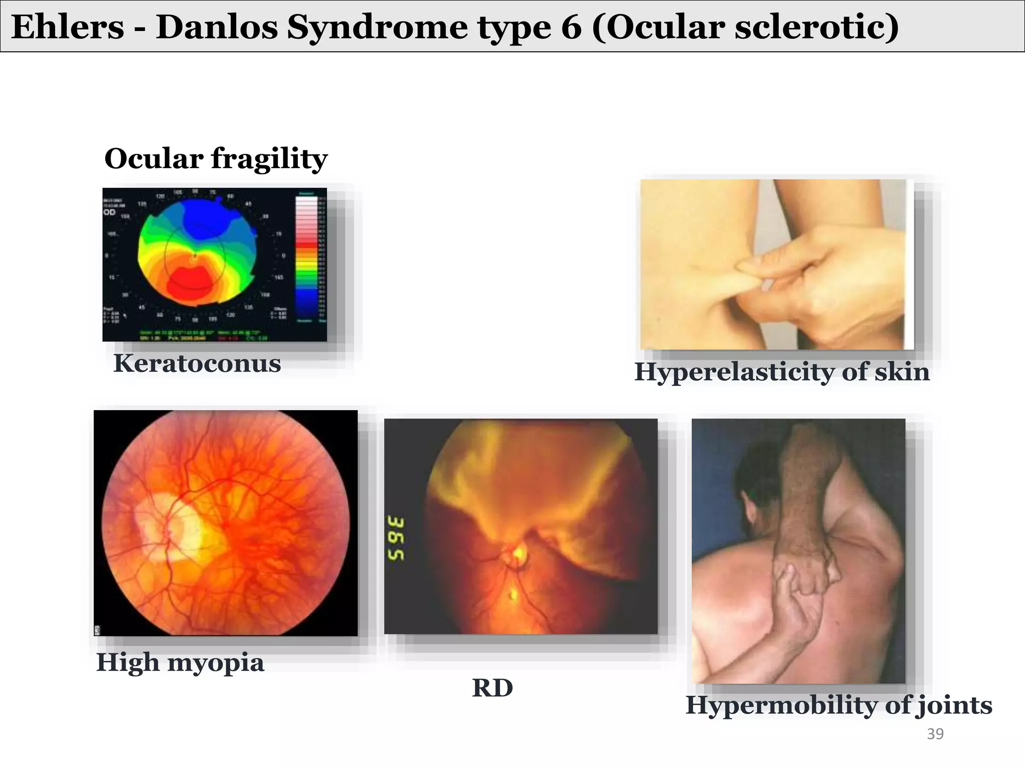Ocular_manifestations_of_systemic_ds..pptx