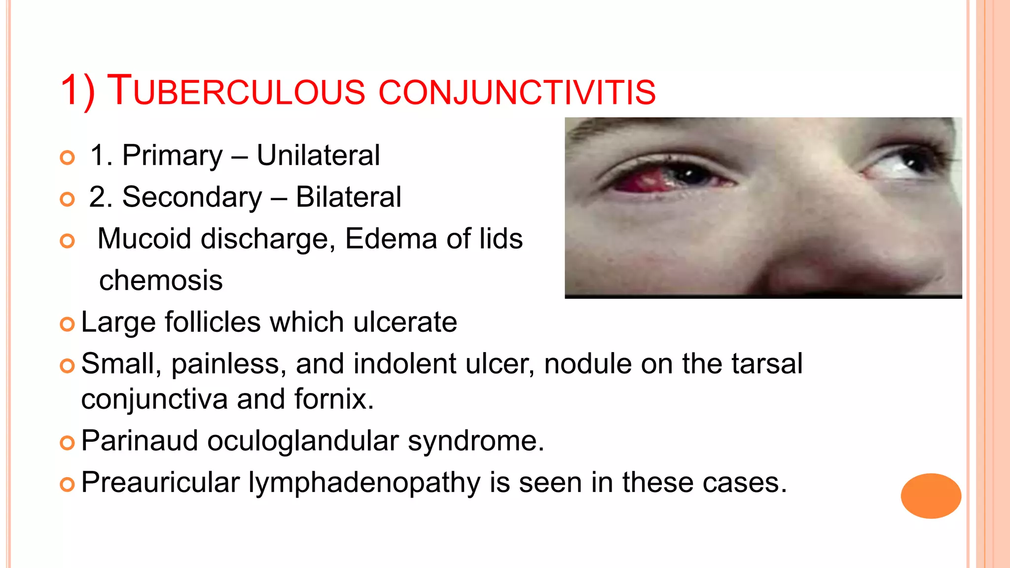 Ocular manifestations of tuberculosis infection | PPTX