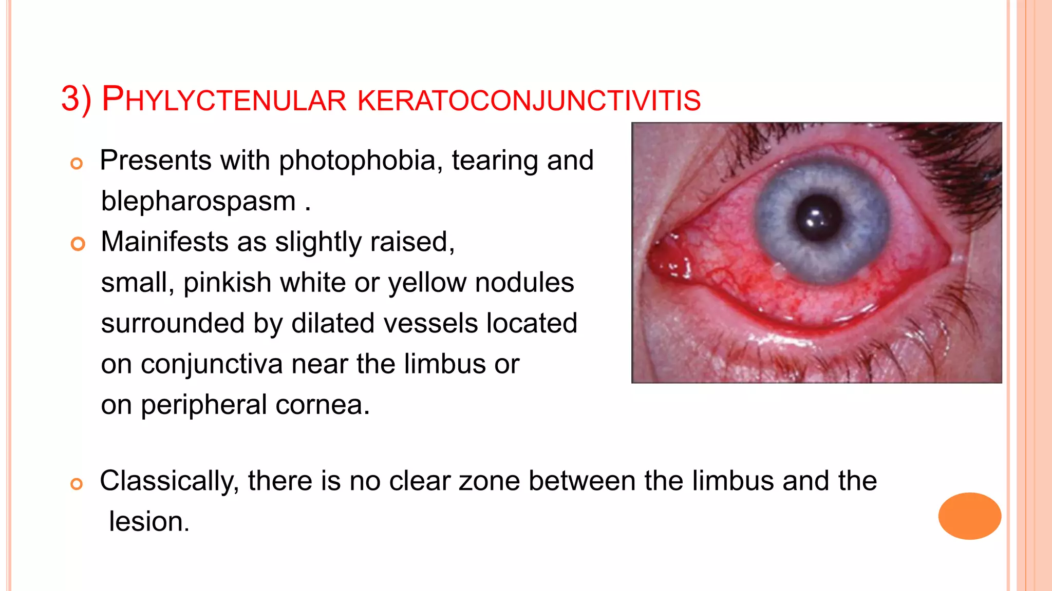Ocular manifestations of tuberculosis infection | PPTX