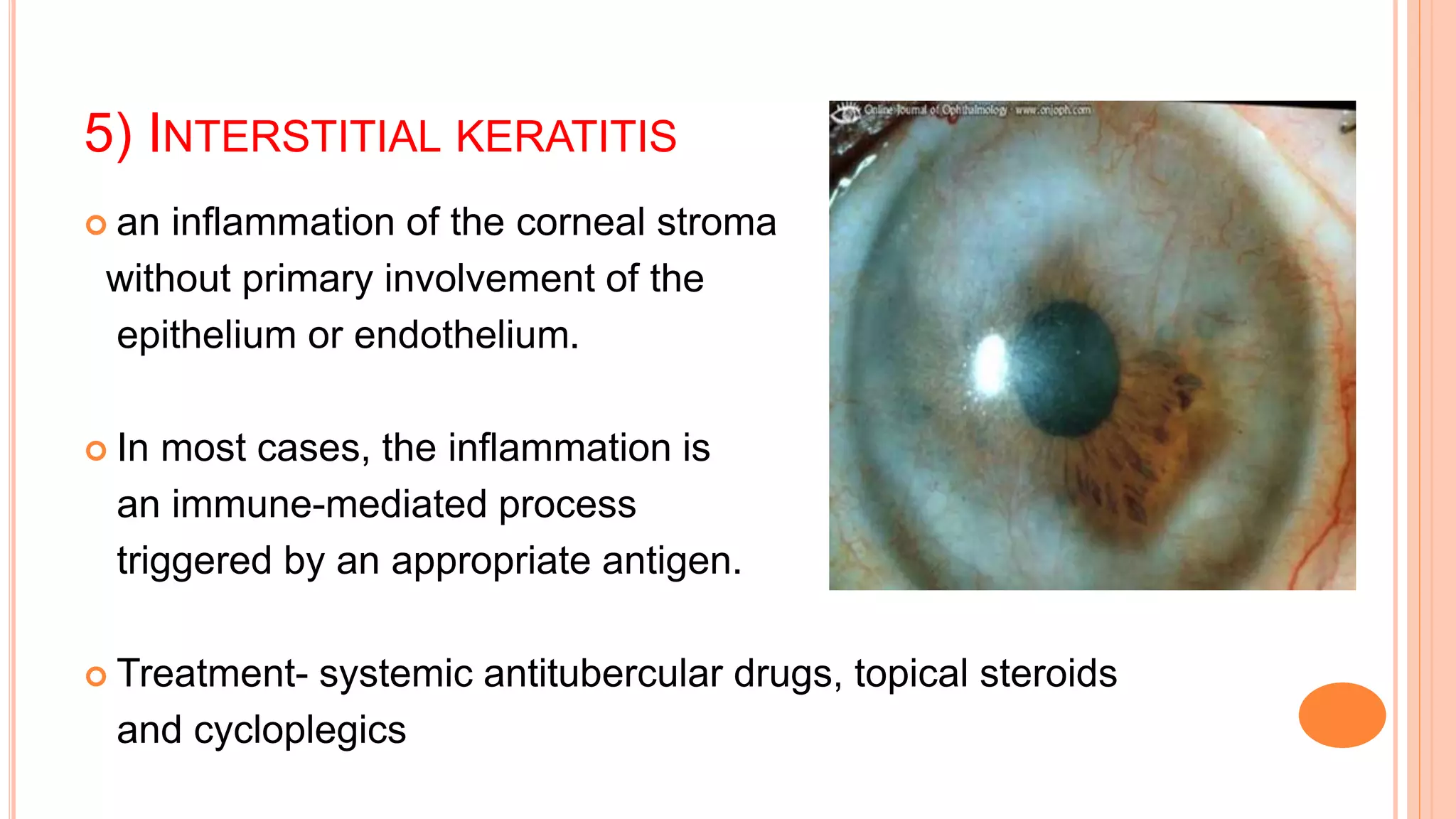 Ocular manifestations of tuberculosis infection | PPTX