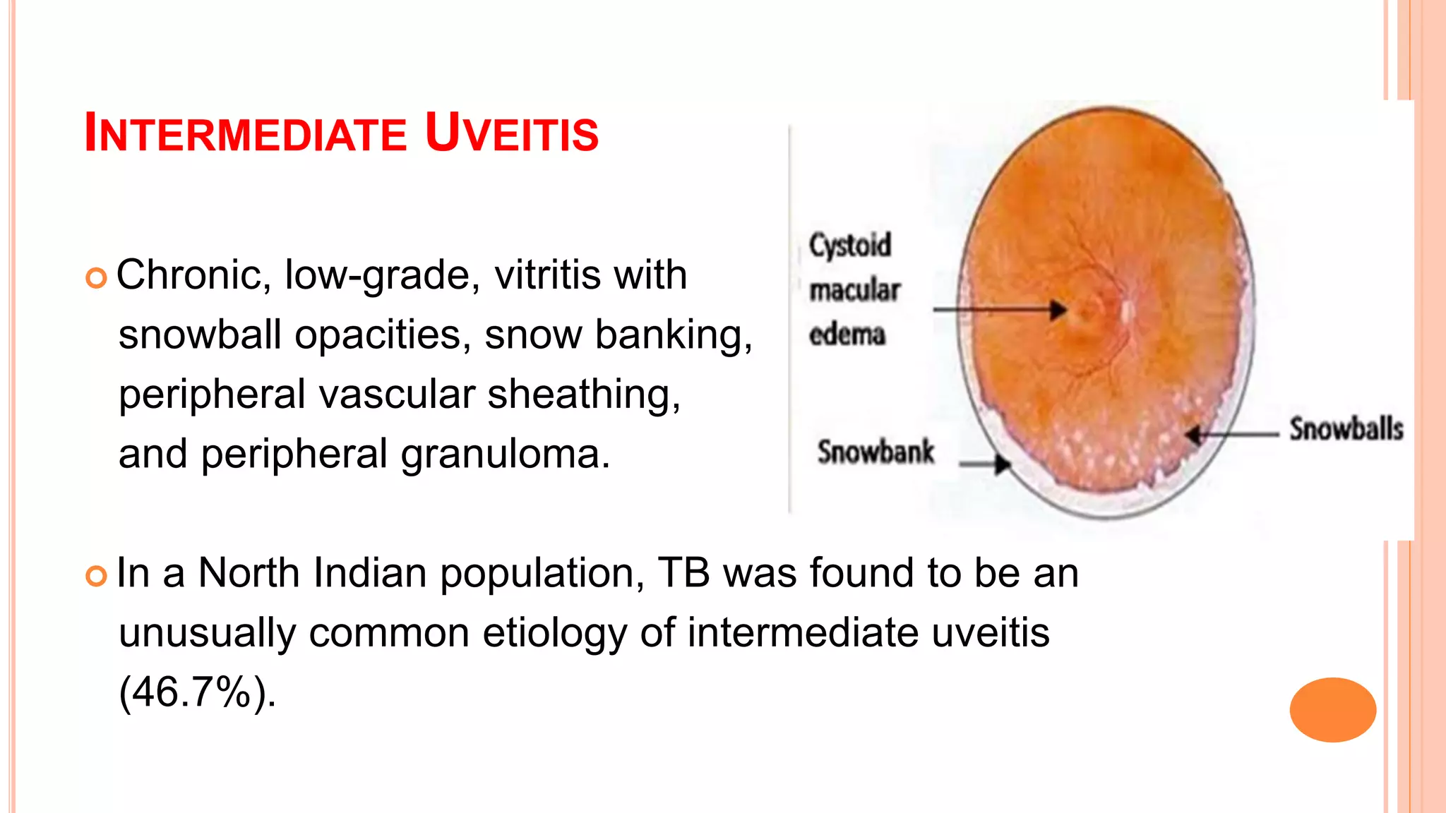 Ocular manifestations of tuberculosis infection | PPTX