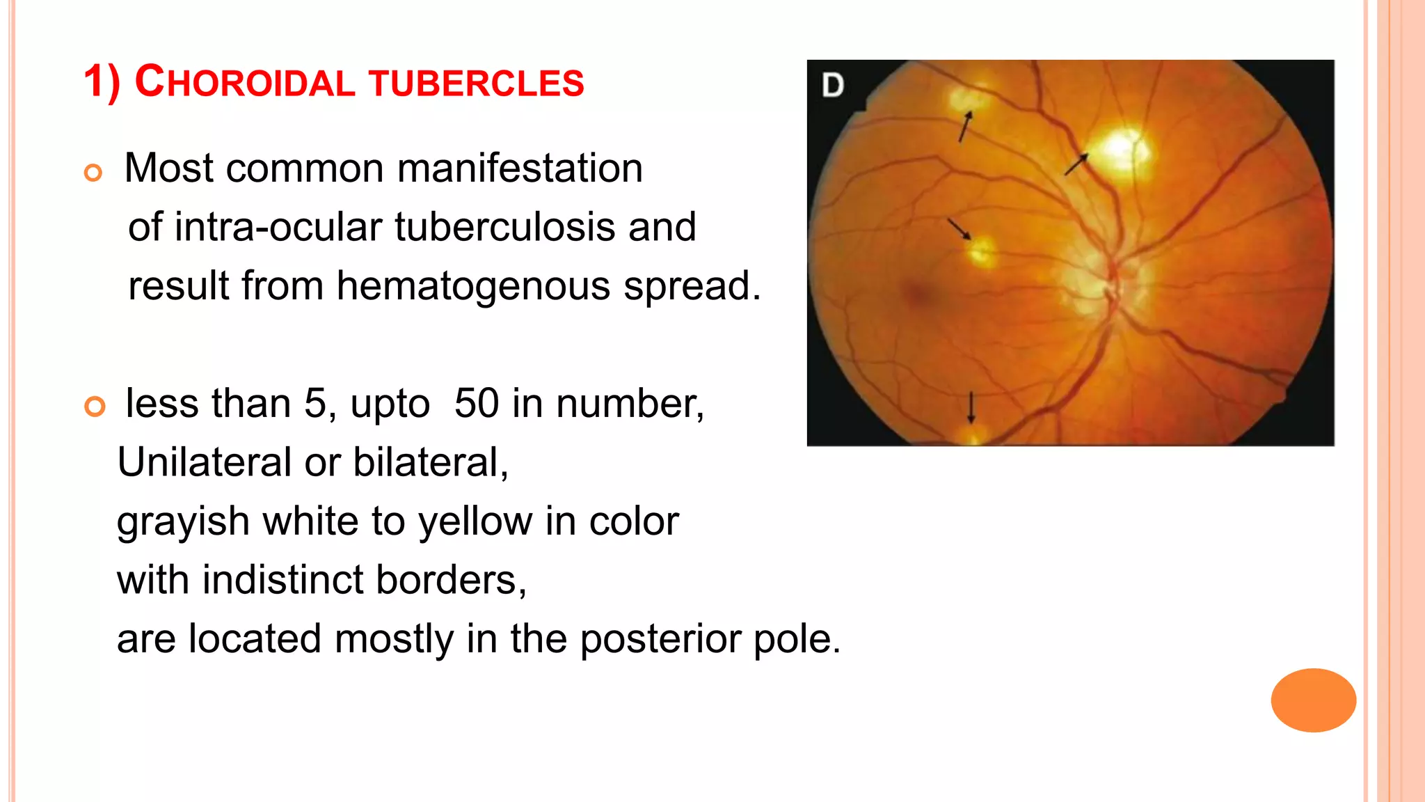 Ocular manifestations of tuberculosis infection | PPTX