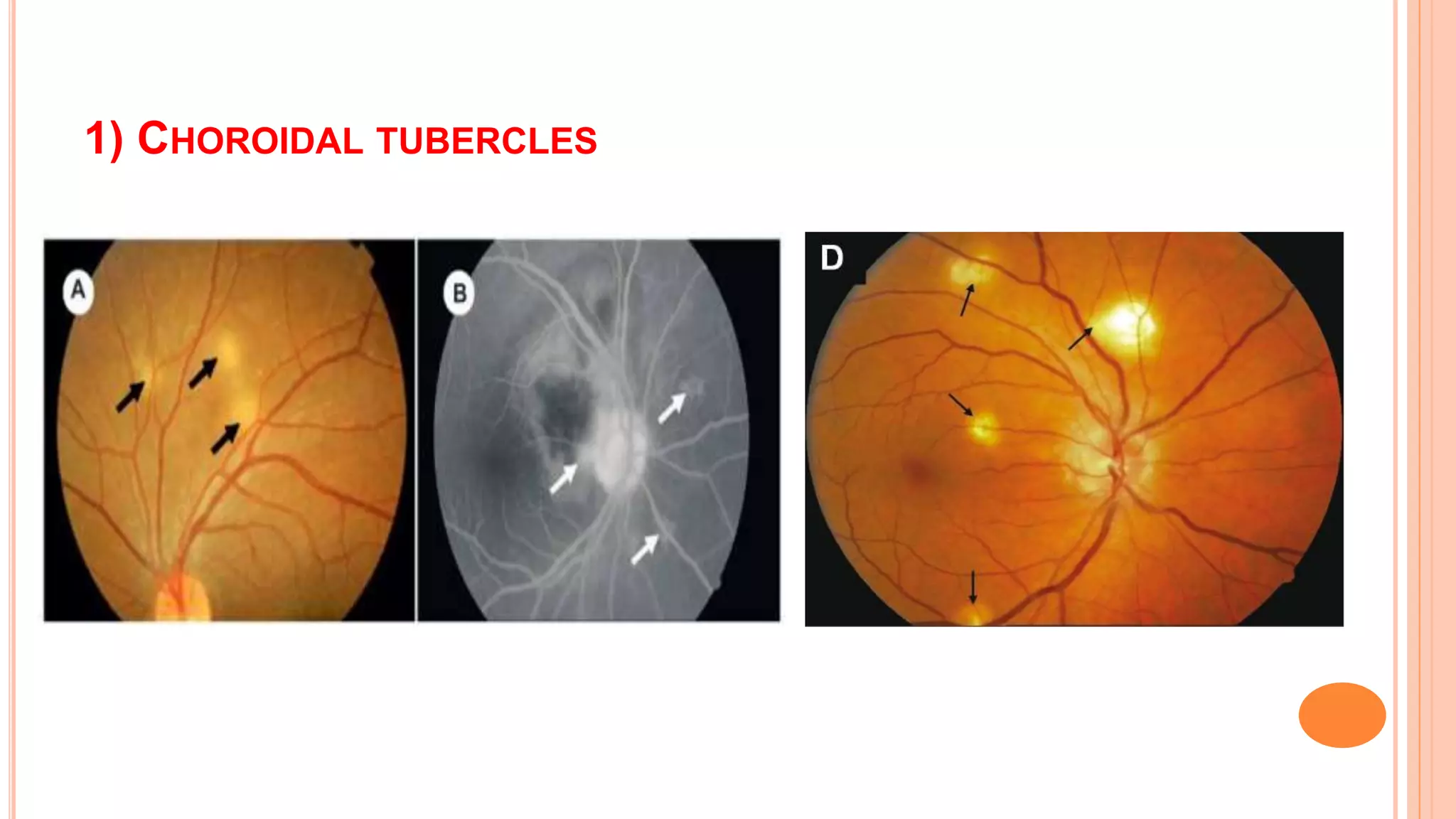 Ocular manifestations of tuberculosis infection | PPTX