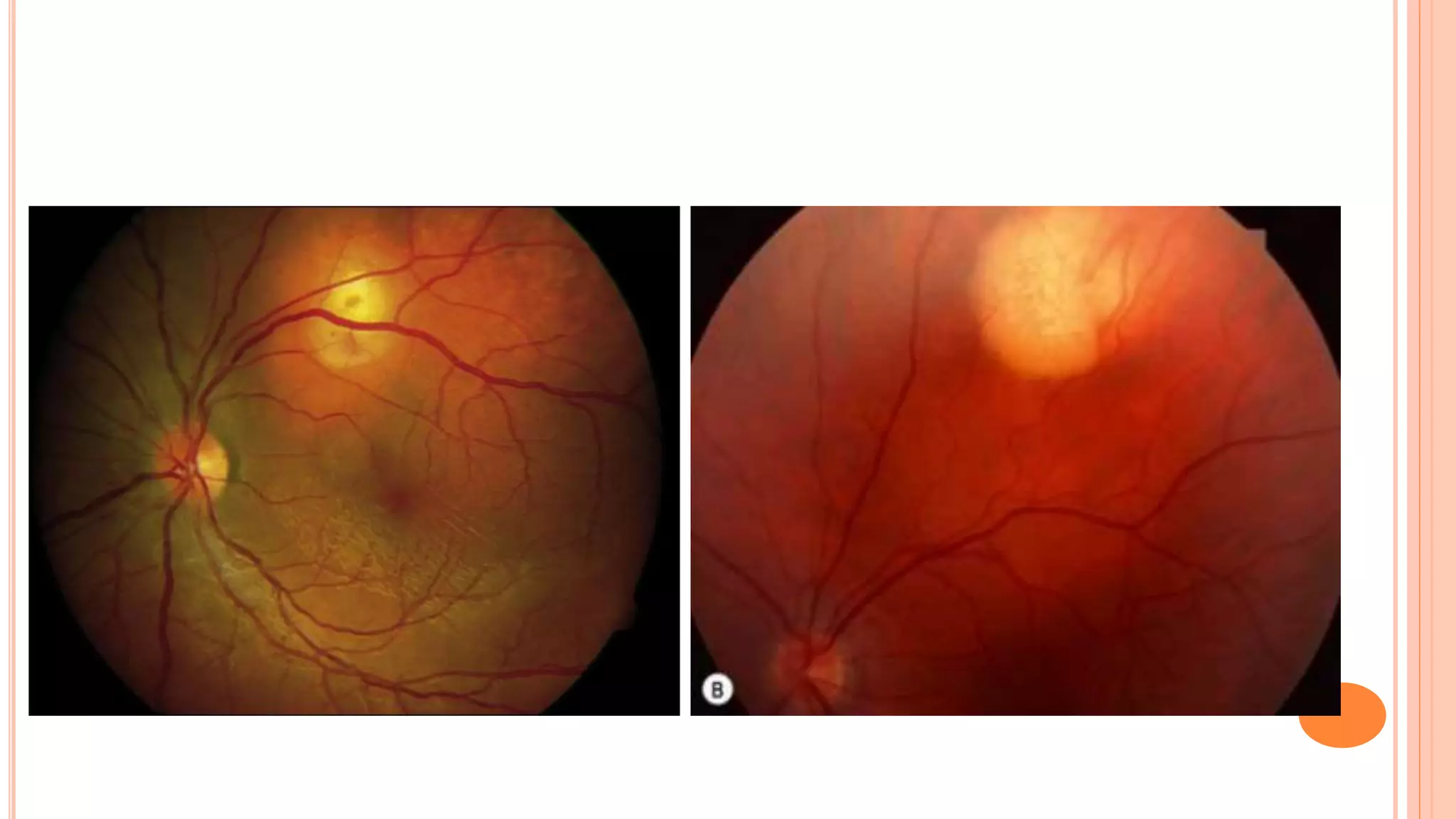 Ocular manifestations of tuberculosis infection | PPTX