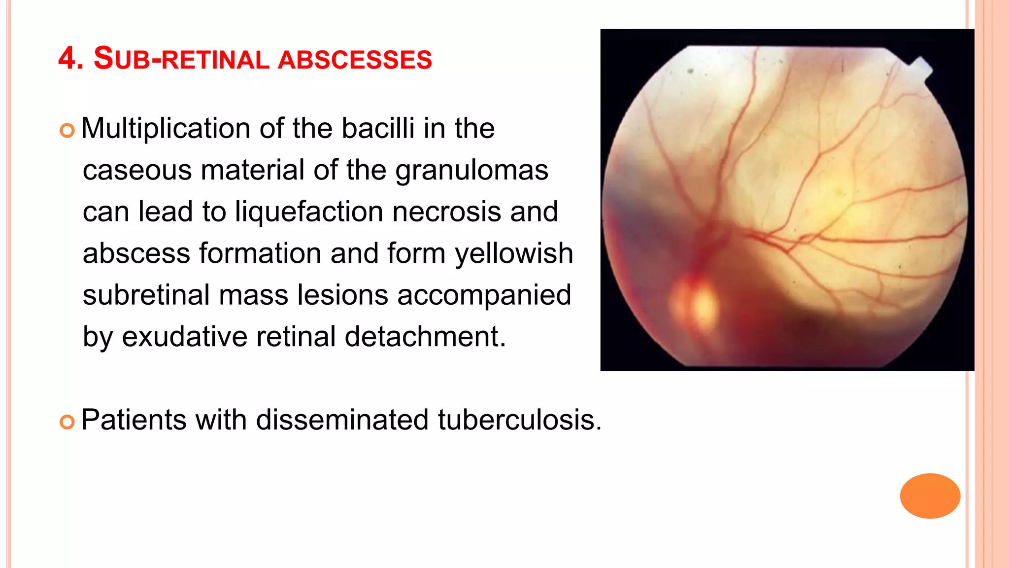 Ocular manifestations of tuberculosis infection | PPTX