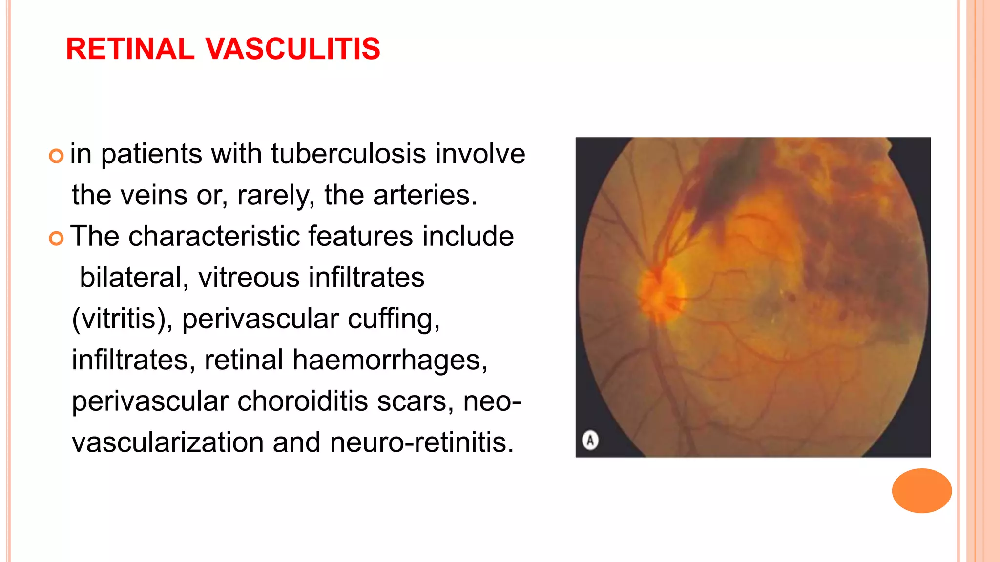 Ocular manifestations of tuberculosis infection | PPTX
