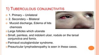 Ocular manifestations of tuberculosis infection | PPTX