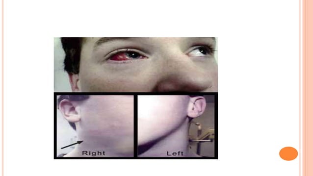 Ocular manifestations of tuberculosis infection | PPTX