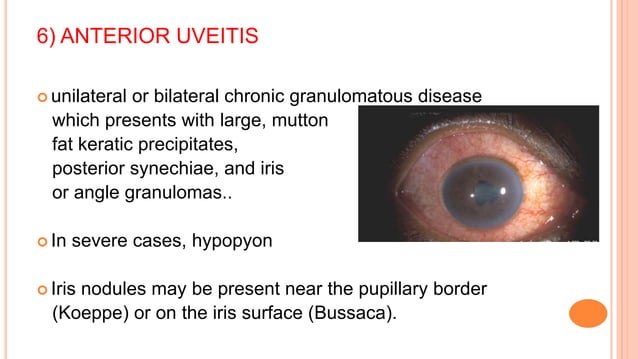 Ocular manifestations of tuberculosis infection | PPTX