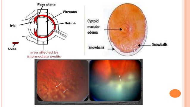 Ocular manifestations of tuberculosis infection | PPTX