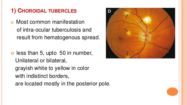 Ocular manifestations of tuberculosis infection