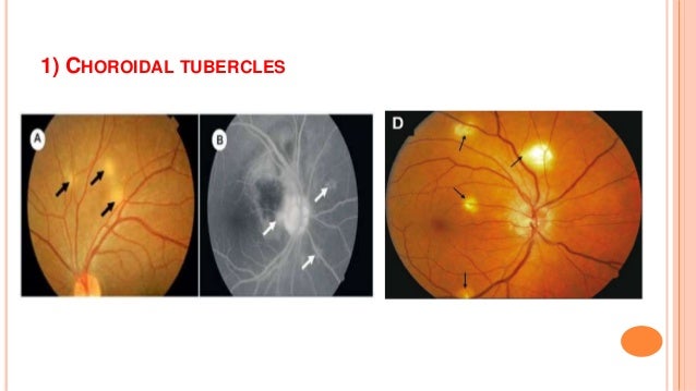Ocular manifestations of tuberculosis infection
