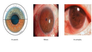 Ocular menifestation of neurological diseases | PPT