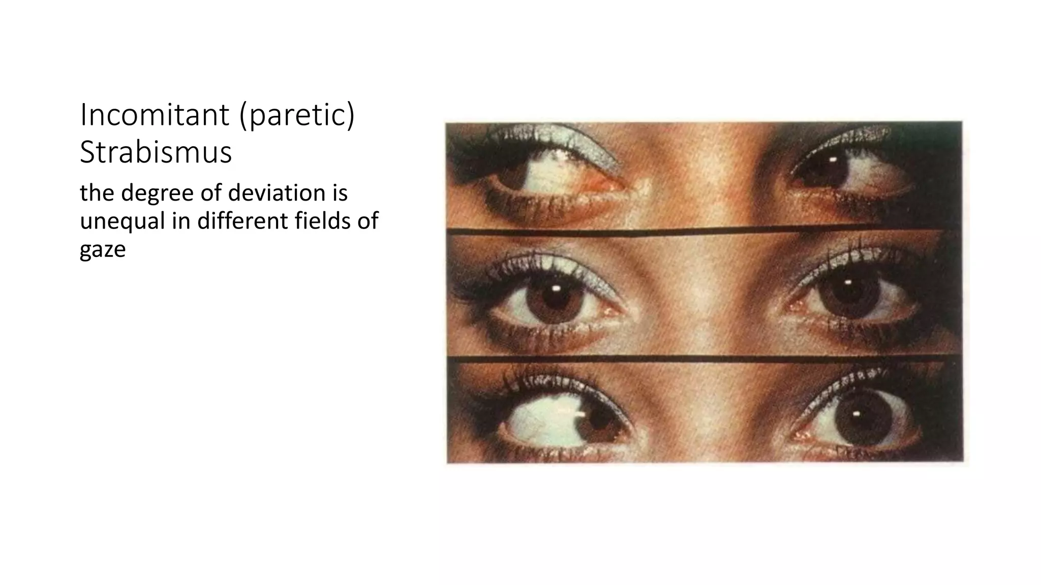 OCULAR MOTILITY.pptx