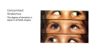 OCULAR MOTILITY.pptx