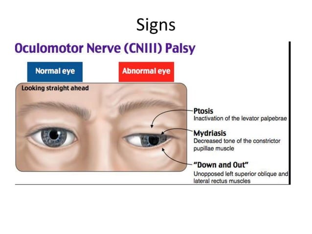 ocular motility disorder wudie.pptx | Eye and Vision Conditions ...