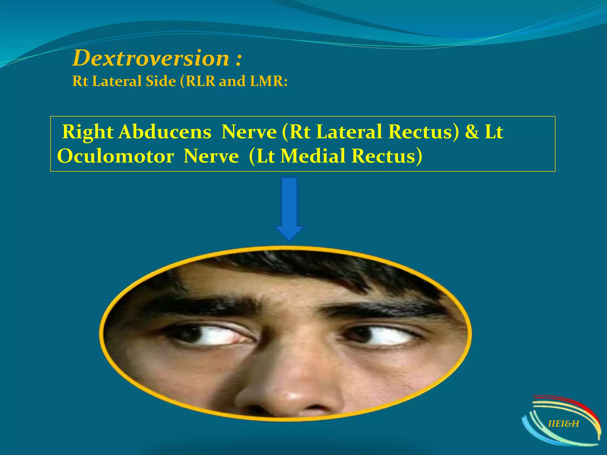 Ocular motility test | PPTX