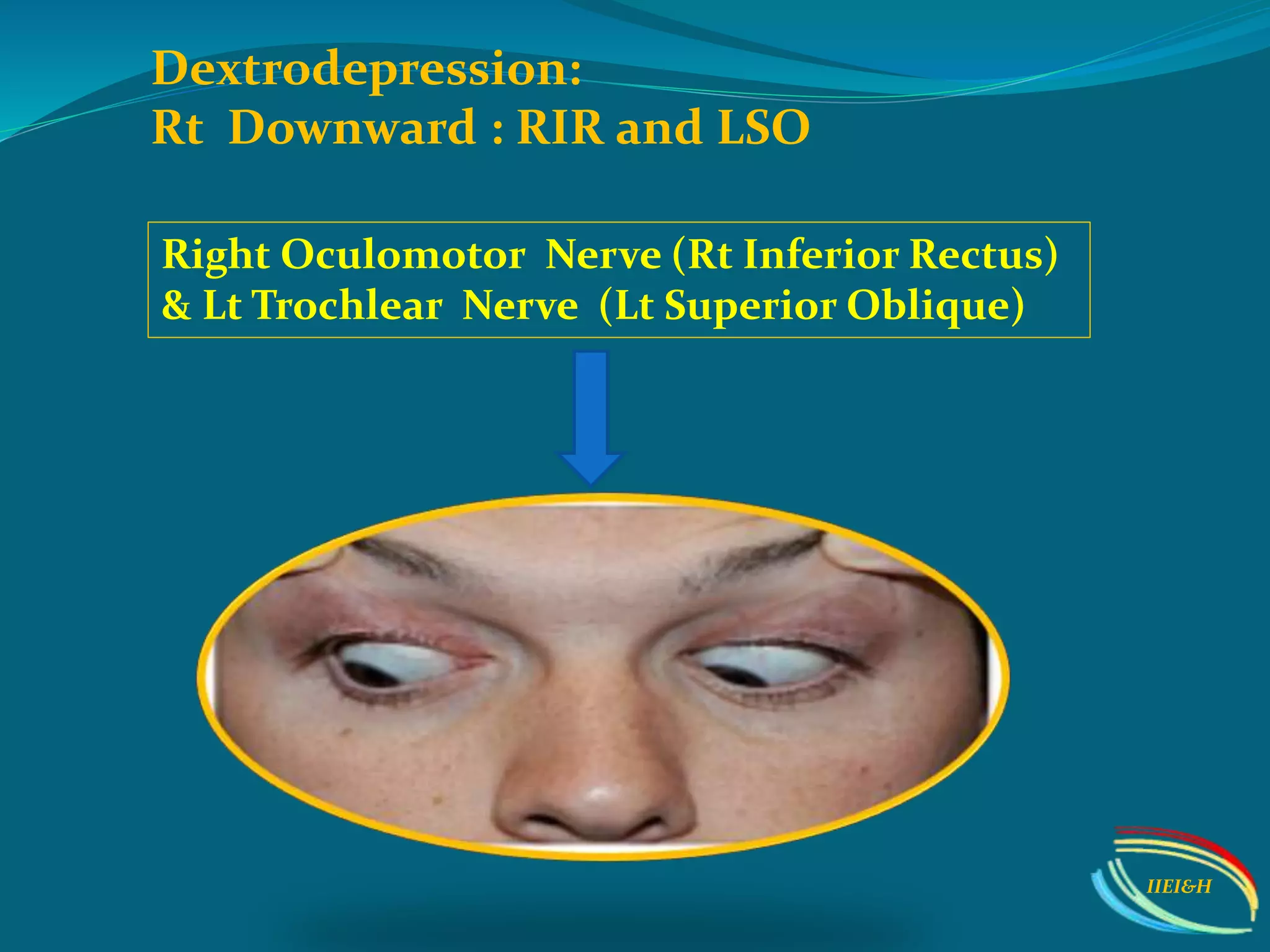 Ocular motility test | PPTX
