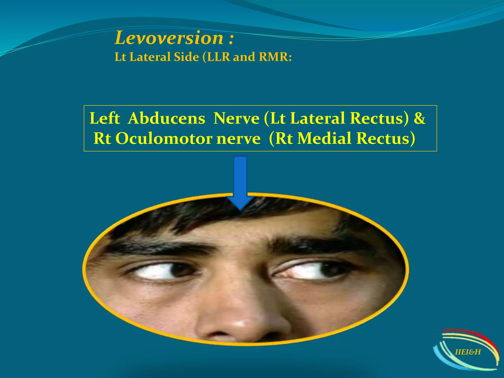 Ocular motility test | PPTX