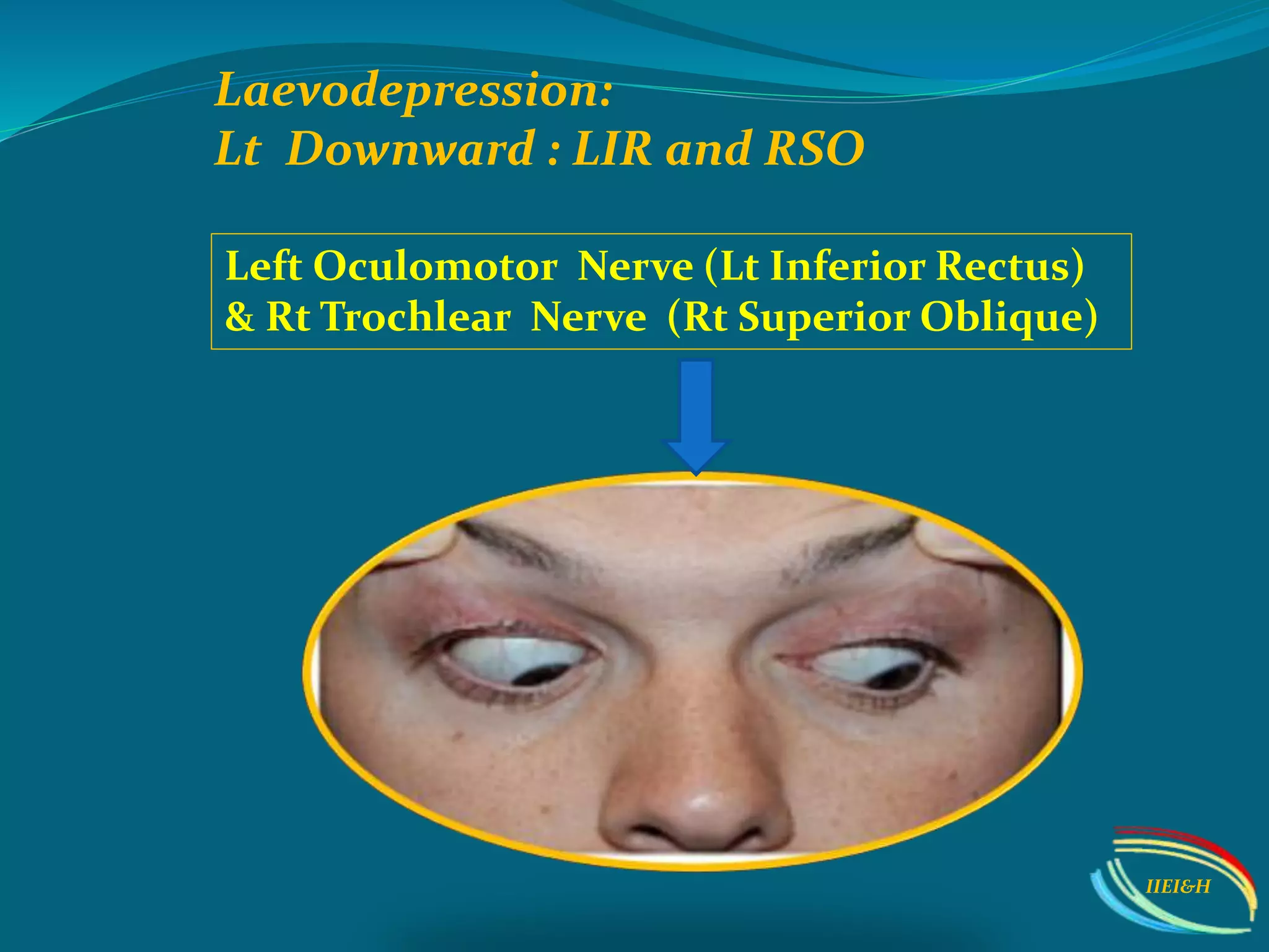 Ocular motility test | PPTX
