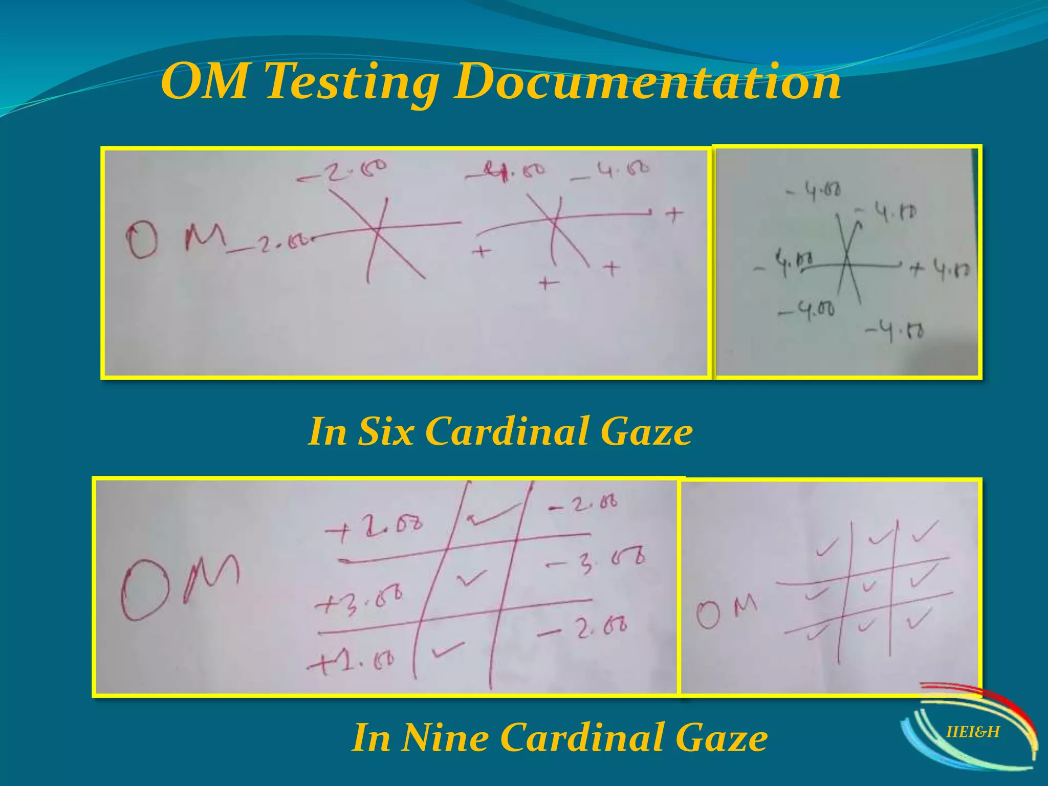 Ocular motility test | PPTX